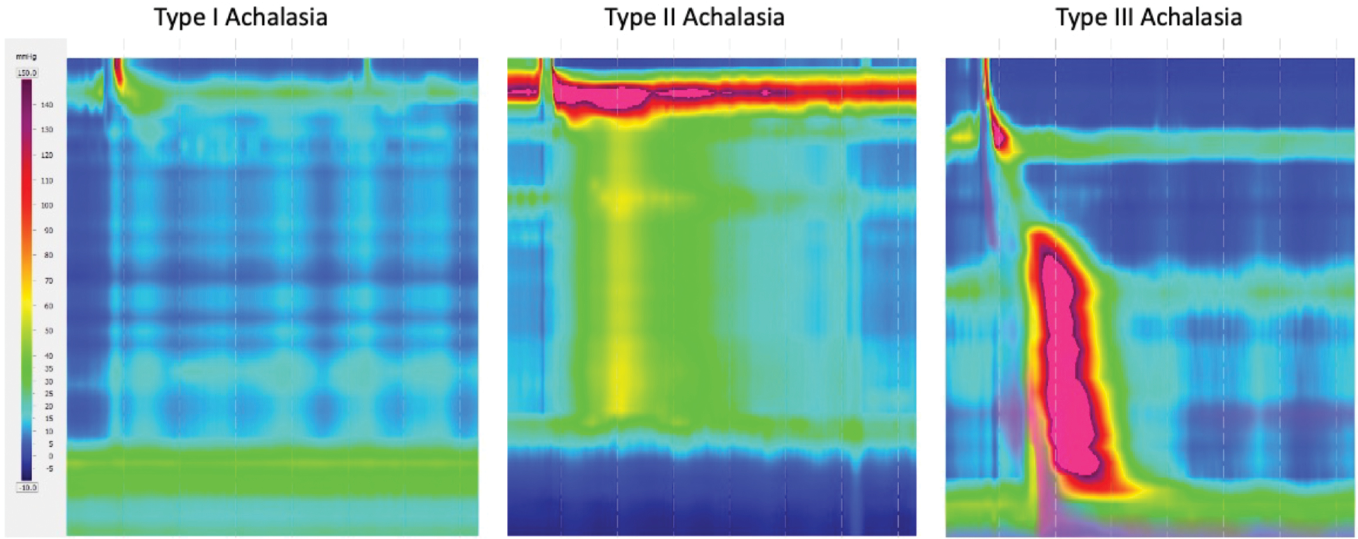 Management of Achalasia