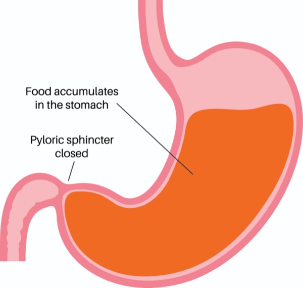 G-POEM Data Show High Success Rates, Symptom Relief in Patients With ...