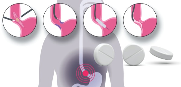Management of Achalasia, Part 2: Treatment