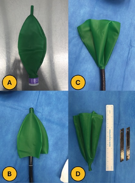Recurrent Intentional Foreign Body Ingestion