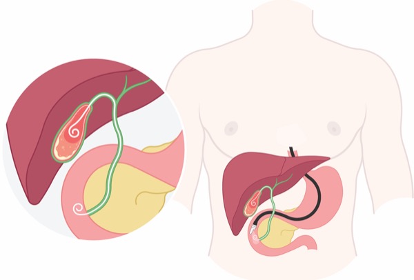 endoscopic ultrasound Rendezvous Procedures Gallbladder Drainage ...