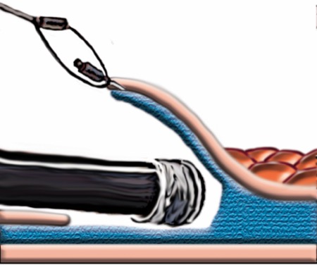 Traction Found to Help Margins in ESD of Esophageal Cancer