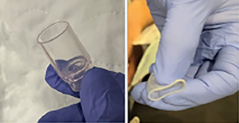 Using the Soft, Mega, Distal Transparent Cap to Remove Food Bolus