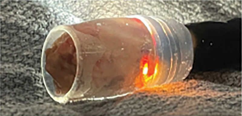 Using the Soft, Mega, Distal Transparent Cap to Remove Food Bolus