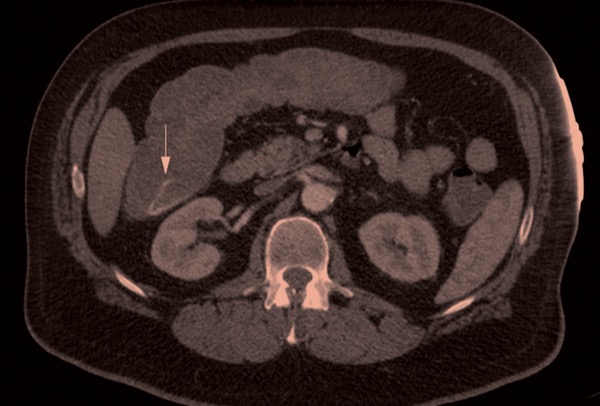 ACG, SAR Issue Recommendations on Imaging Tests for GI Bleeding