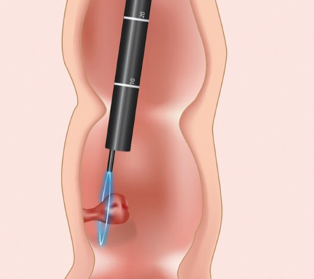 cold snare polypectomy tips and tricks