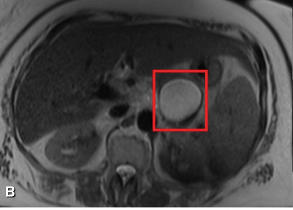 pancreas pancreatic cysts lesions imaging