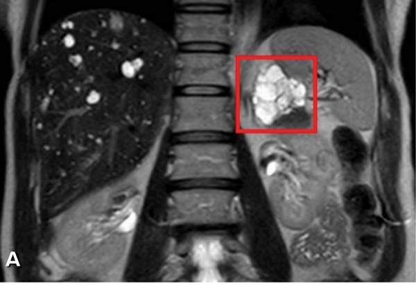 Pancreatic Cystic Lesions: A Case-Based Approach