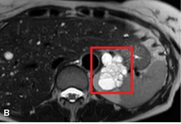 Pancreatic Cystic Lesions: A Case-Based Approach