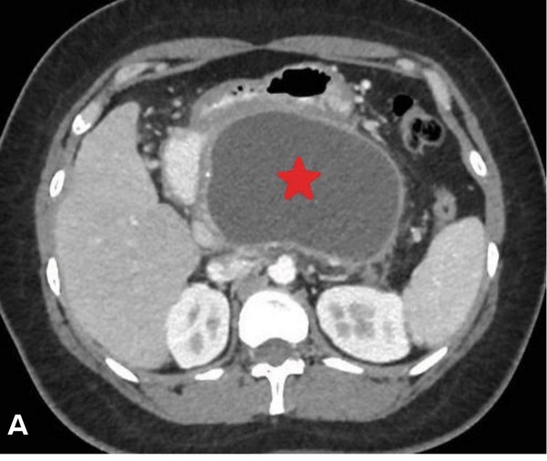 pancreas pancreatic cysts lesions imaging