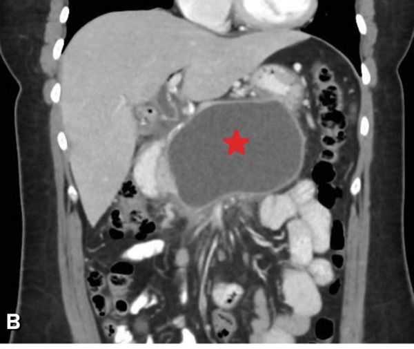 Pancreatic Cystic Lesions: A Case-Based Approach