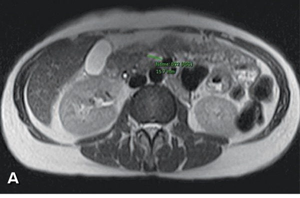 Pancreatic Cystic Lesions: A Case-Based Approach