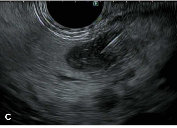 Pancreatic Cystic Lesions: A Case-Based Approach