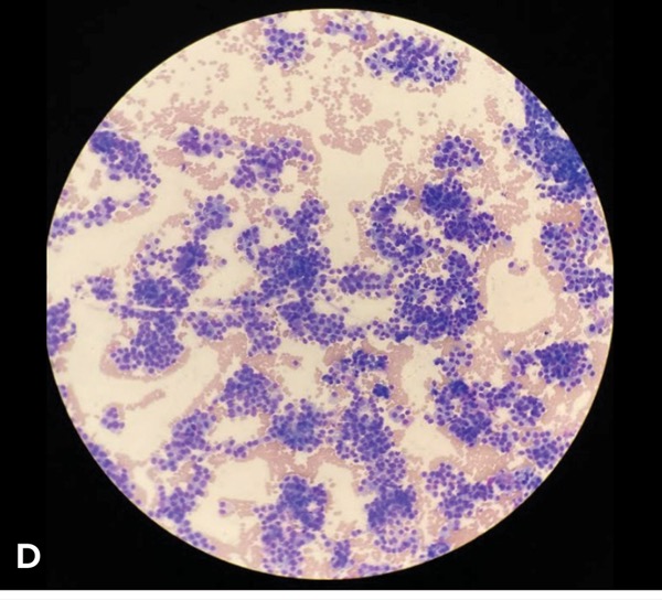 Pancreatic Cystic Lesions: A Case-Based Approach