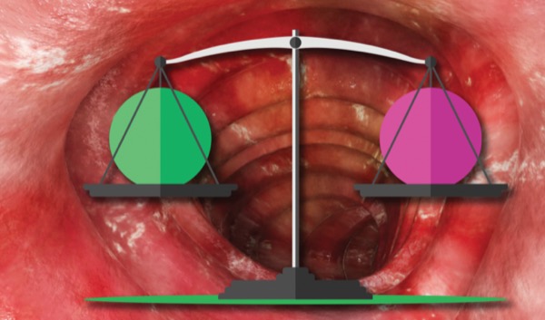 Upadacitinib Versus Tofacitinib in UC; Etrasimod for Proctitis