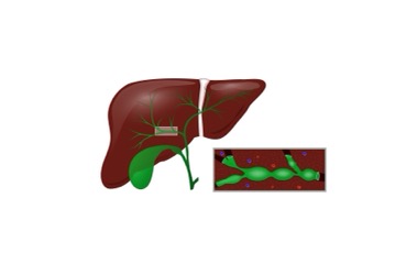 FDA Approves Elafibranor Iqirvo Ipsen Primary Biliary Cholangitis