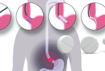 Achalasia esophageal disorder management and treatment
