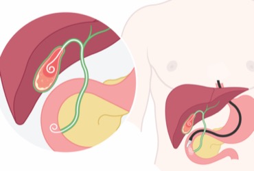 endoscopic ultrasound Rendezvous Procedures Gallbladder Drainage ...