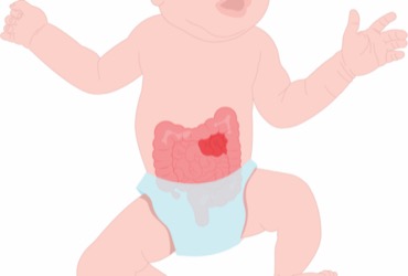 preterm infants probiotics necrotizing enterocolitis premie care FDA ...