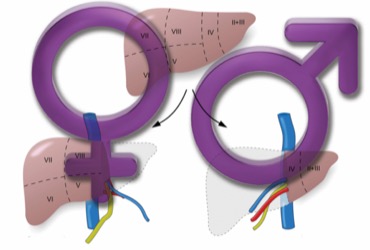 MELD 3.0 Aims to Address Bias in Liver Transplant List Selection