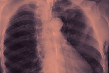 endoscopic eradication therapy Barrett's esophagus AGA guideline Joel H ...