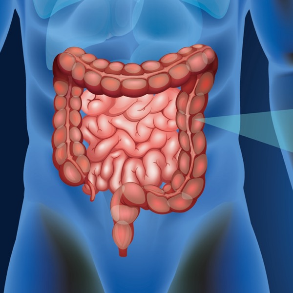 IBD IBS Crossover Management UC Ulcerative Colitis