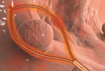 Study Documents Risks Of Hot Snare for Small Polyps