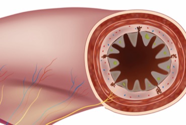 Crohn's Disease Transmural Healing Study