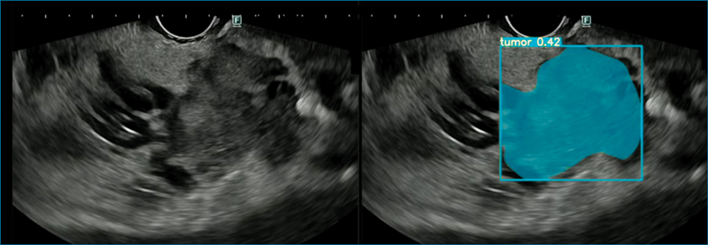 AI-Driven EUS Pancreatic Lesion Detection Bhutani's Eye on Endosonography