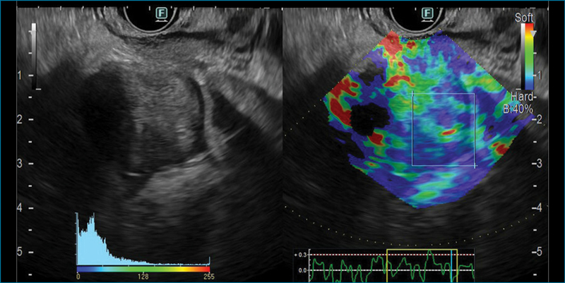 AI-Driven EUS Pancreatic Lesion Detection Bhutani's Eye on Endosonography