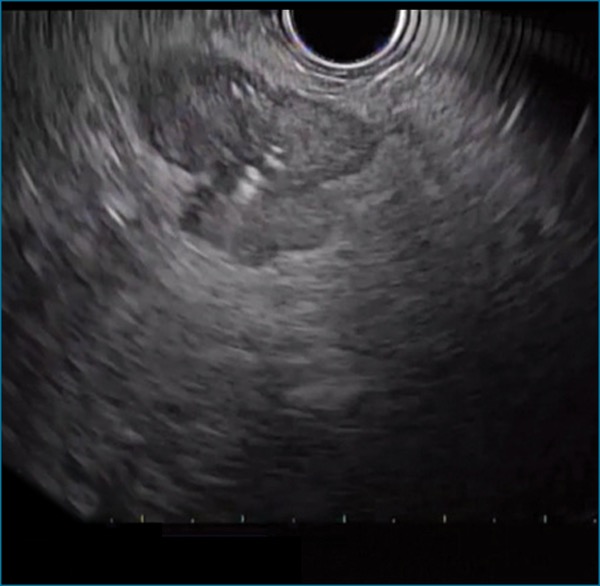 AI-Driven EUS Pancreatic Lesion Detection Bhutani's Eye on Endosonography