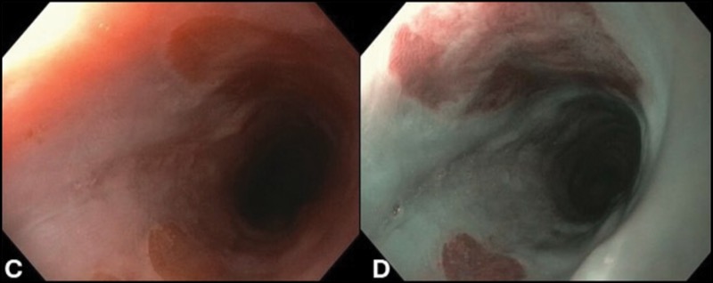 Inlet Patches Ablation Techniques endoscopy