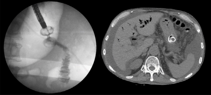 EUS-Guided Gastroenterostomy For Gastric Outlet Obstruction