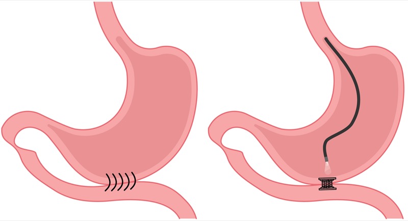 EUS-Guided Gastroenterostomy For Gastric Outlet Obstruction