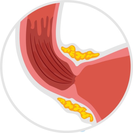 Barrett's Esophagus Management Strategies