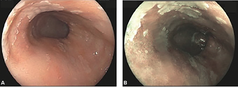 Barrett's Esophagus Management Strategies