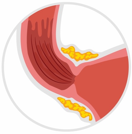 BE Management Reflux Medical Approach