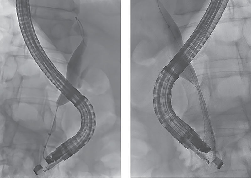 Therapeutic Endoscopic Ultrasound Innovations