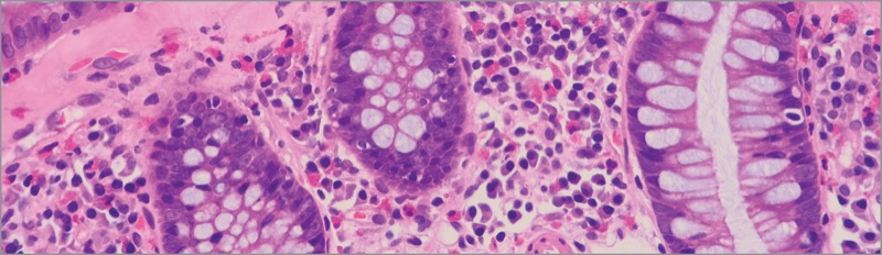 Disease Clearance Ulcerative Colitis Treatment