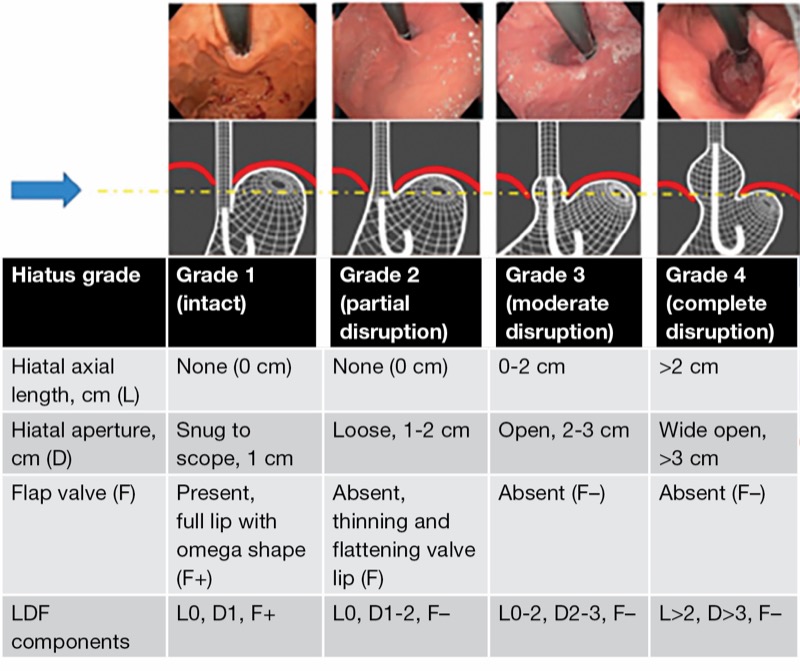 High Quality Upper Endoscopy