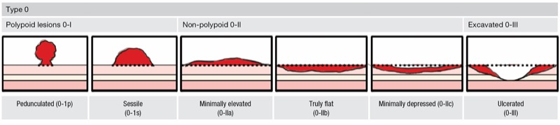 High Quality Upper Endoscopy