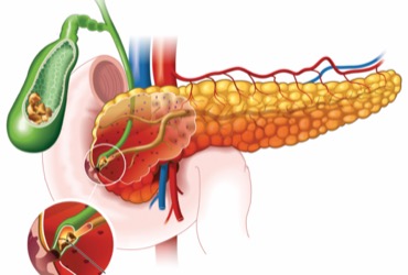 Acute Pancreatitis Clinical Guideline