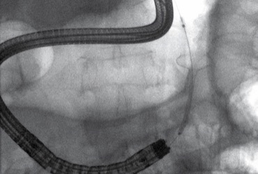 EUS-GE Endoscopic Ultrasound-Guided Gastroenterostomy