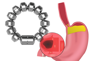 Eradication Therapy Safety Barrett’s Esophagus
