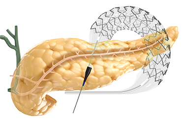 Pancreatic Duct Stents Often Pass Spontaneously Study